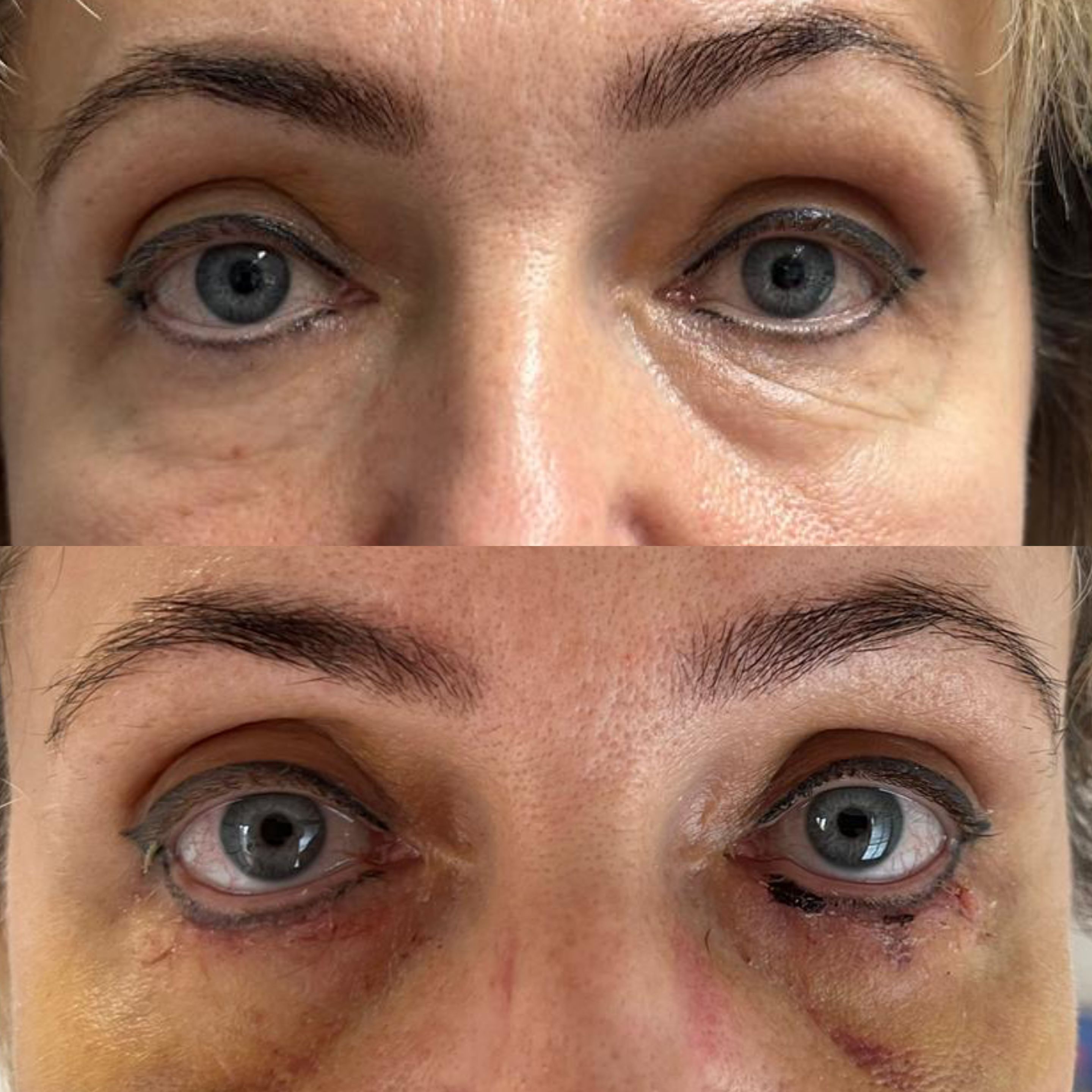 Blefaroplastika: pred a po - Estheticon.sk