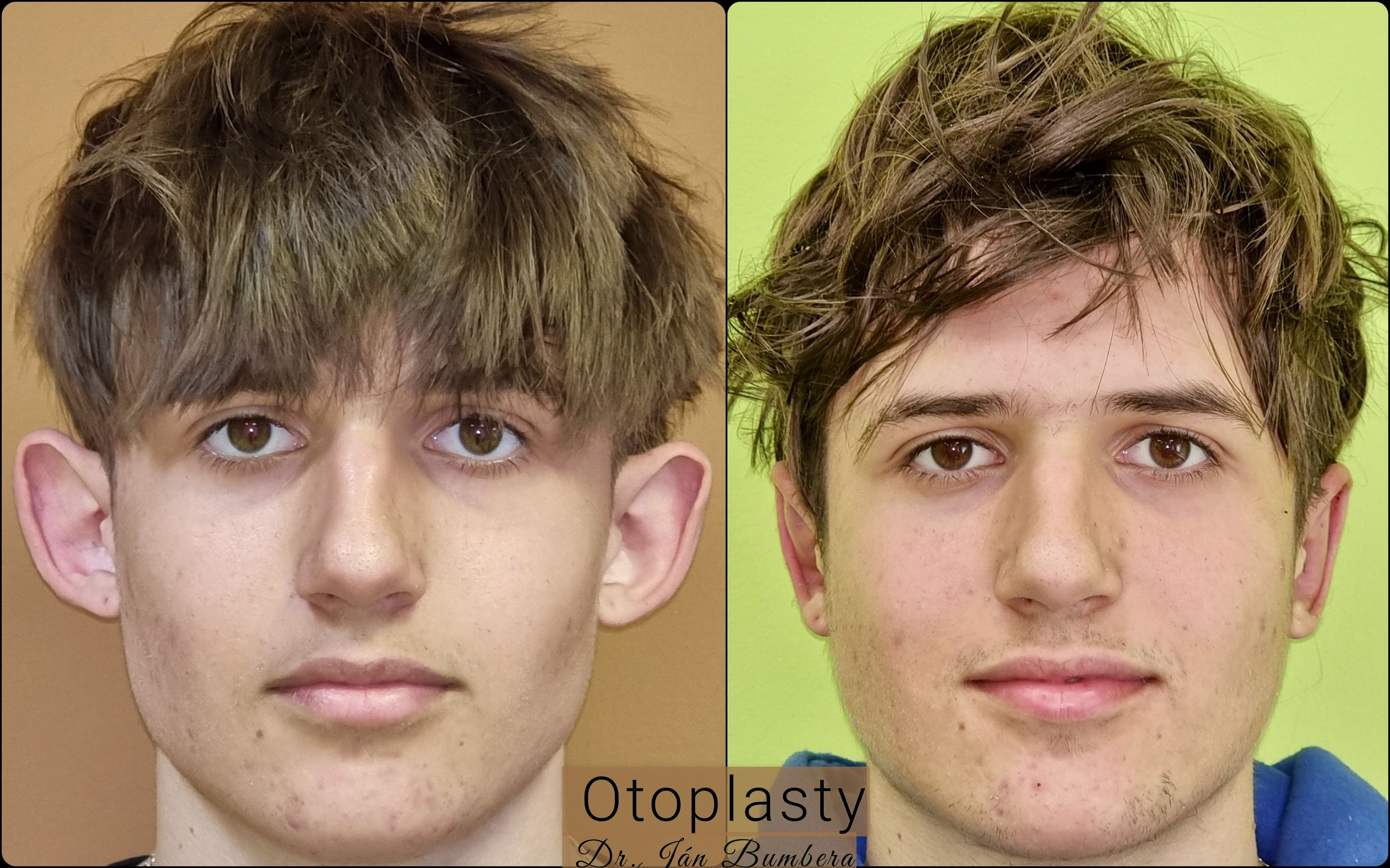 Otoplastika: pred a po - Estheticon.sk - Estheticon.sk