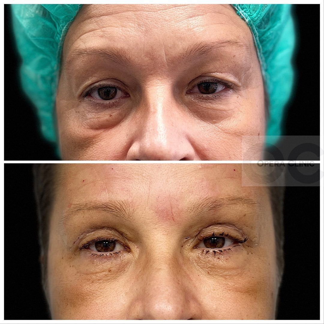 Operácia očných viečok (Blepharoplastika): pred a po - Estheticon.sk ...