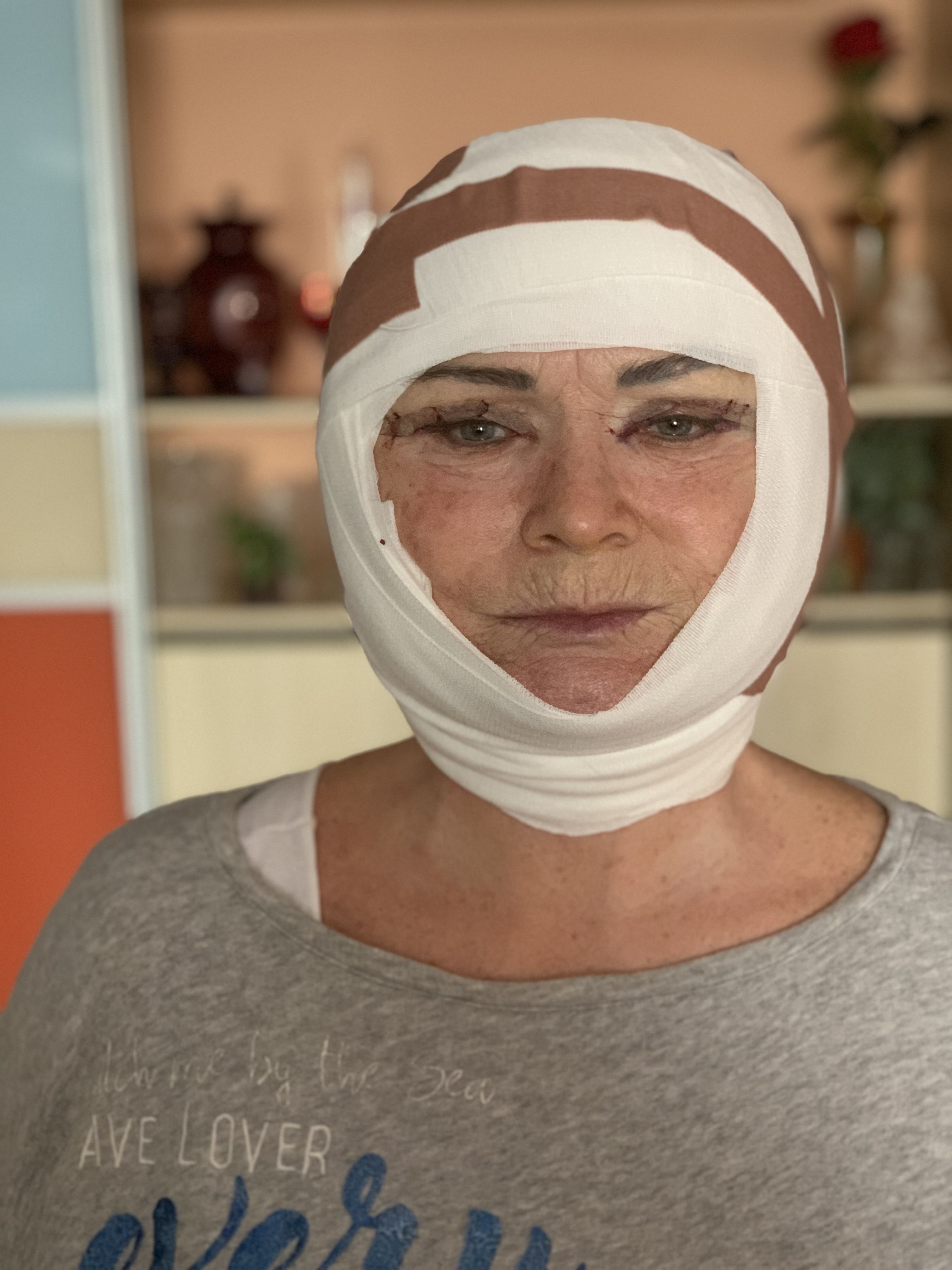 Lifting tvare a krku, očne viečka - Facelift - Estheticon.sk